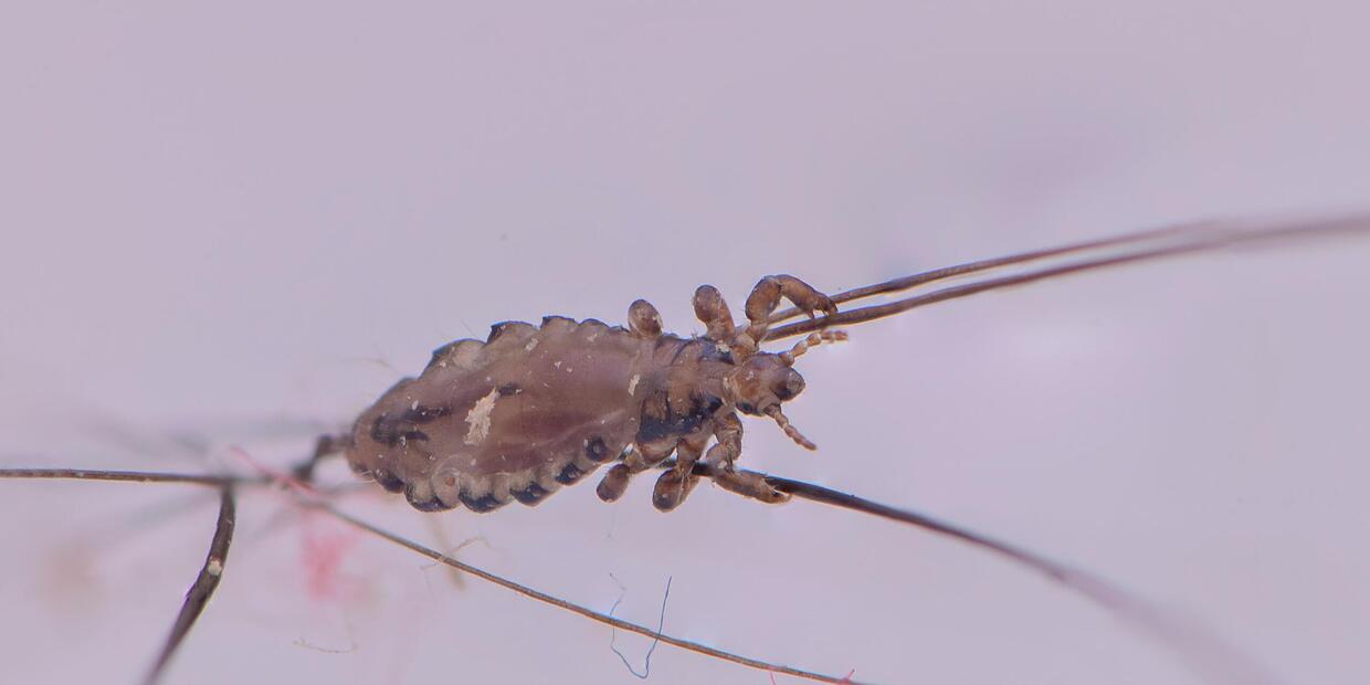 Kopfläuse in Ebensfelder Kita: Die Kinder machen einen Befall zum ...